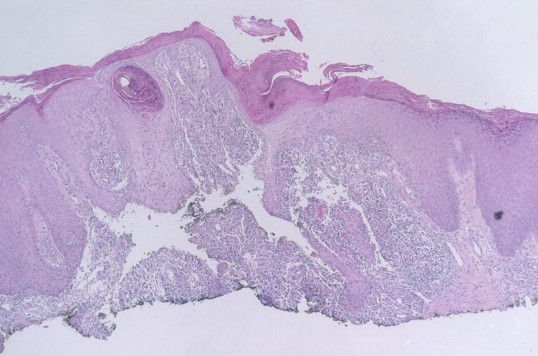 Human Mycobacterium marinum Aronson Infections - Fish Care